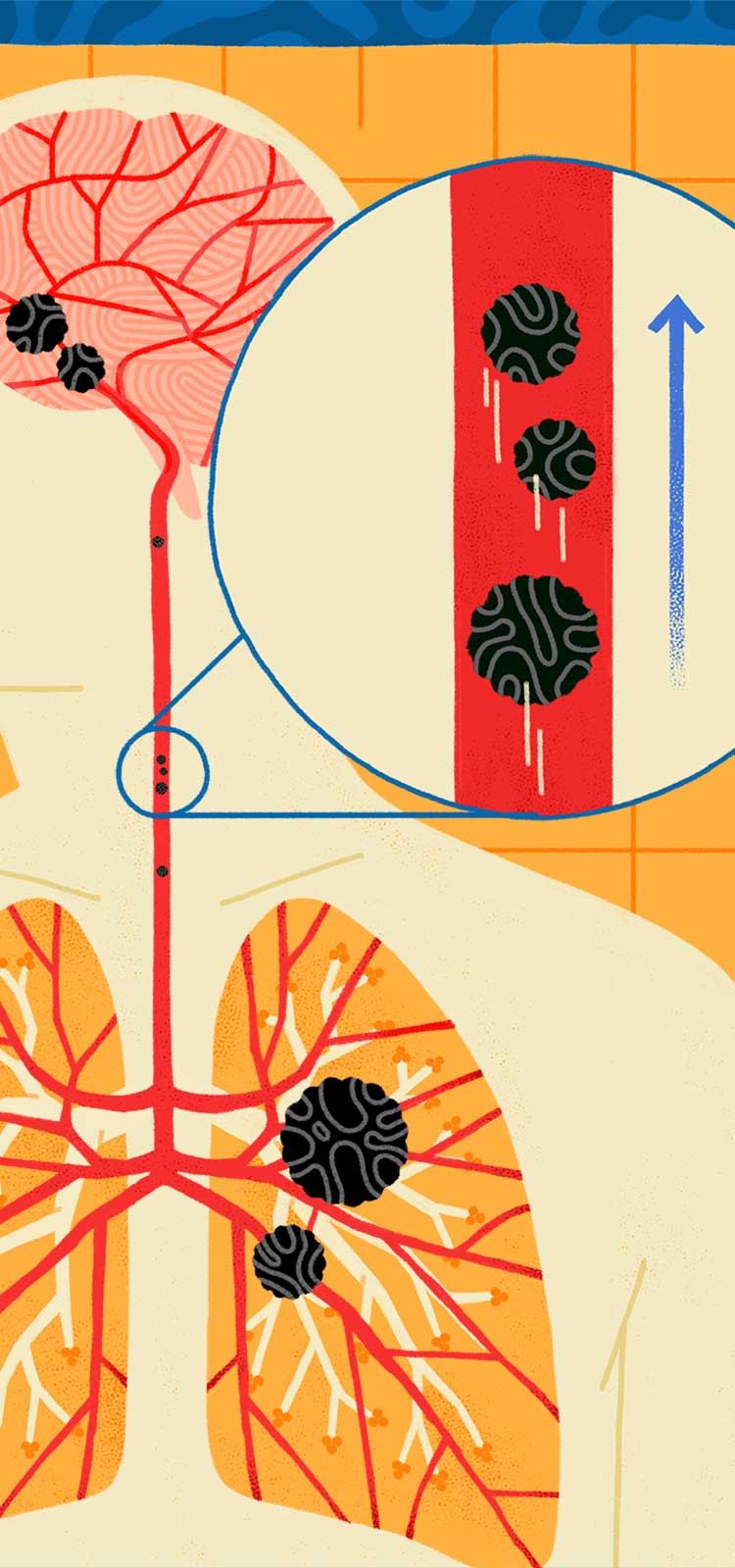 Genentech Reaching Metastases In The Brain genentech-reaching-metastases-in-the-brain