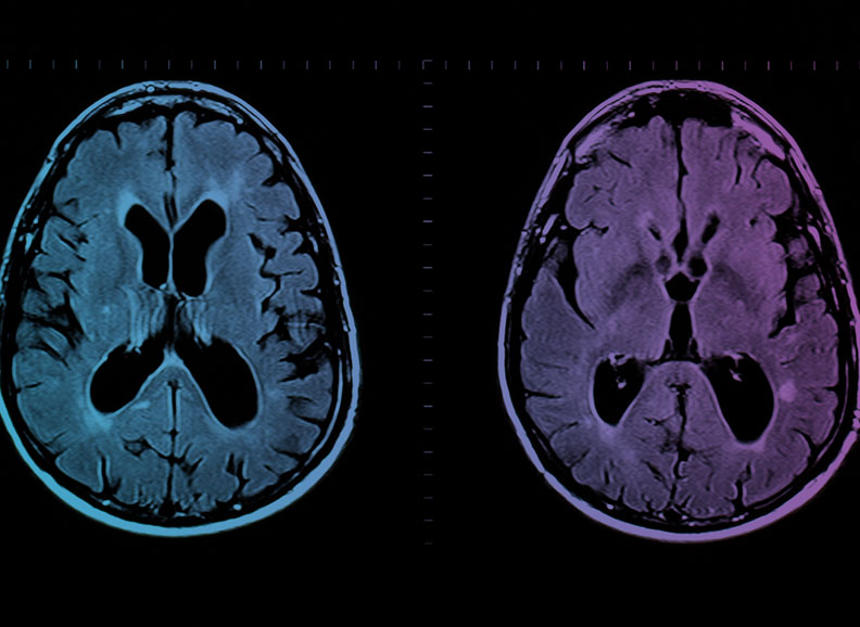 Genentech: The Immune System in Multiple Sclerosis