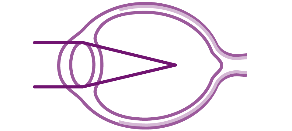 Genentech: UNDERSTANDING mCNV