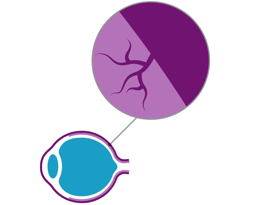 Genentech: UNDERSTANDING mCNV