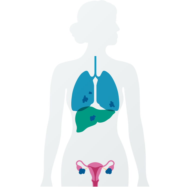 Genentech Understanding Ovarian Cancer