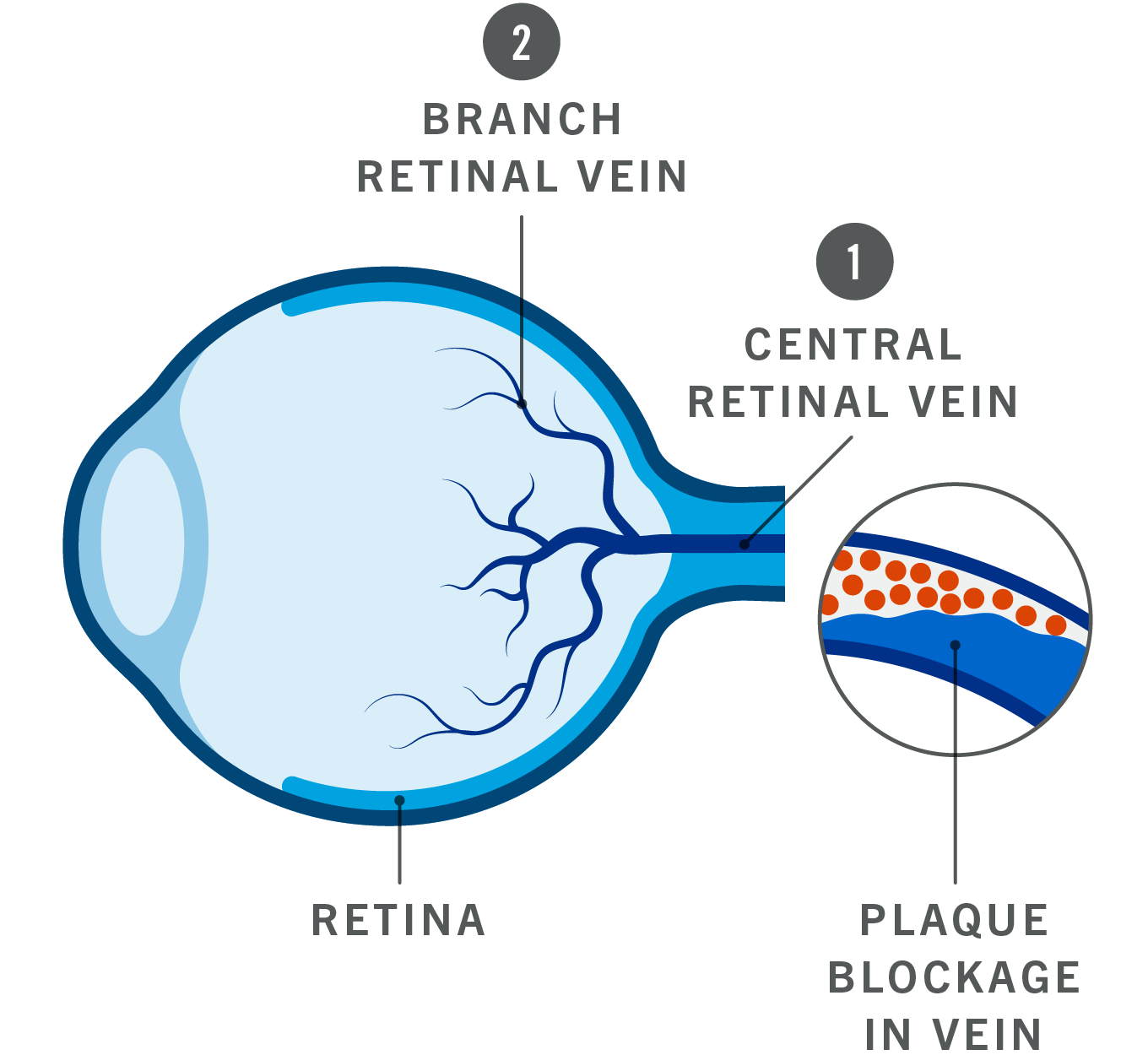 Genentech: Understanding Retinal Vein Occlusion