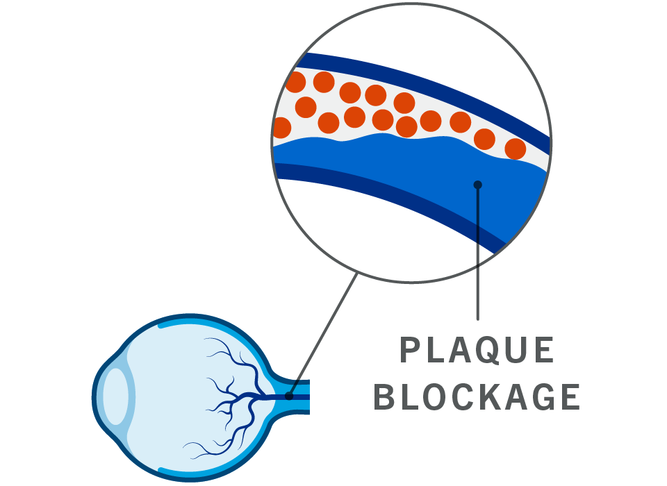 Genentech: Understanding Retinal Vein Occlusion