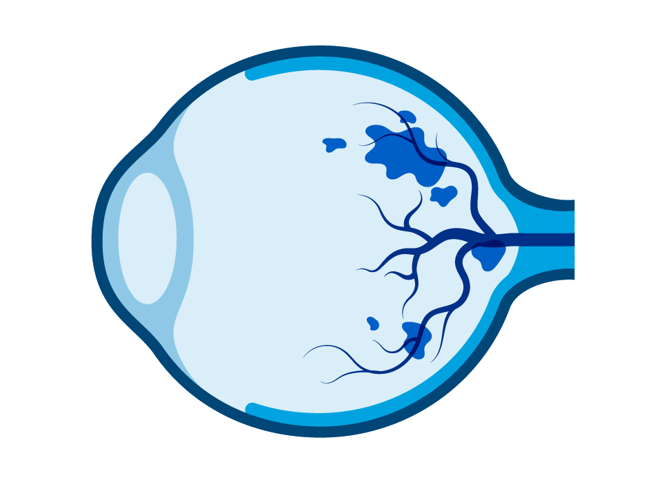 Genentech: Understanding Retinal Vein Occlusion